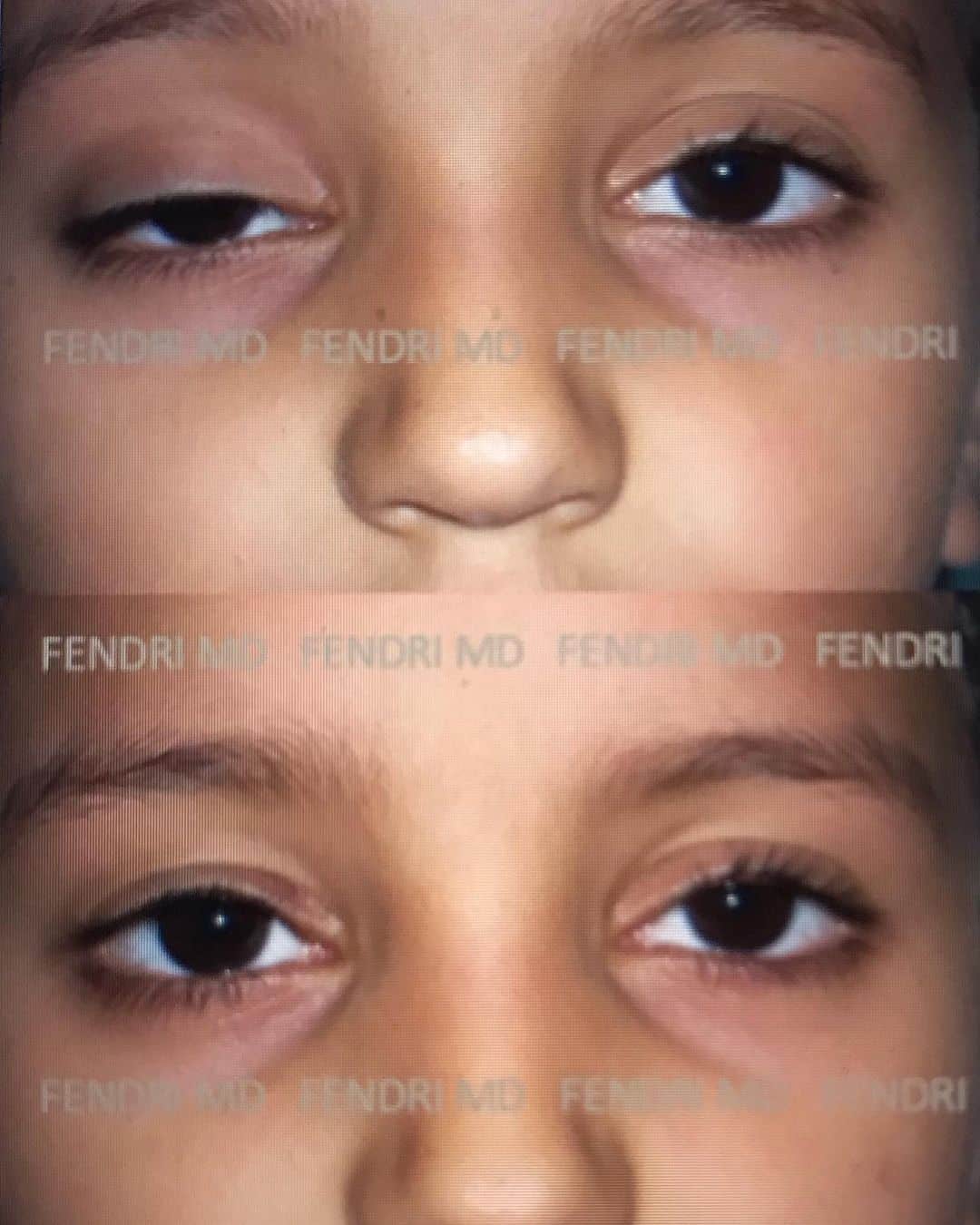 Ptôsis – Cabinet Dr. Mehdi FENDRI